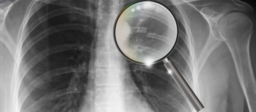 Costilla rota: ¿Cómo actuar?